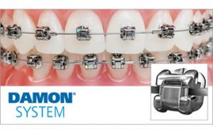 Autoligado Pasivo Damon Q® - Grupo Odontológico Malavé